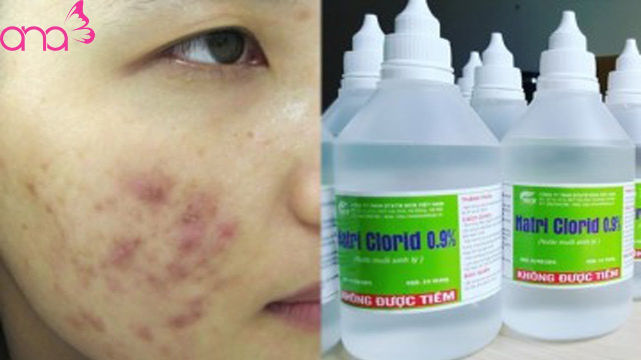 Có nên rửa mặt bằng nước muối sinh lí? - Ana Beauty Academy